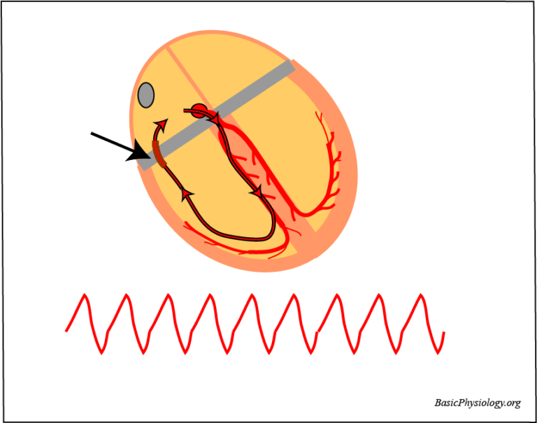 B.7.5. Ventricular Arrhythmias – BasicPhysiology.org
